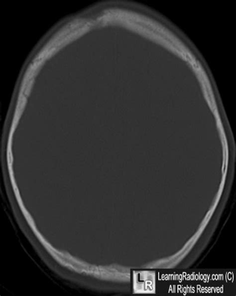 Learningradiology Eosinophilic Granuloma Eg Skull Langerhans