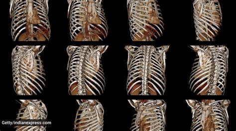 Theres No Evidence That Ct Angio Prevents Sudden Heart Attacks And Deaths In Those Without