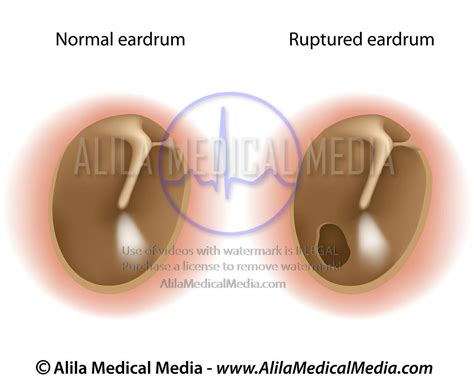 Alila Medical Media Ruptured Eardrum Medical Illustration