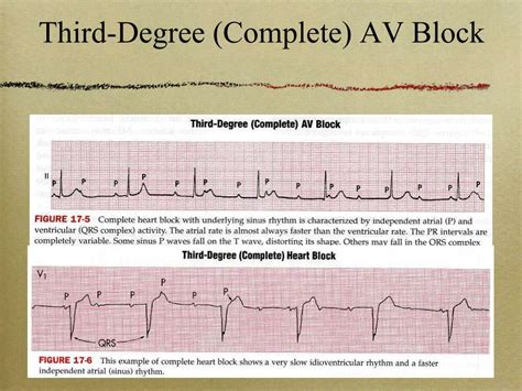 Ppt Wolff Parkinson White And Atrioventricular Av Heart Blocks