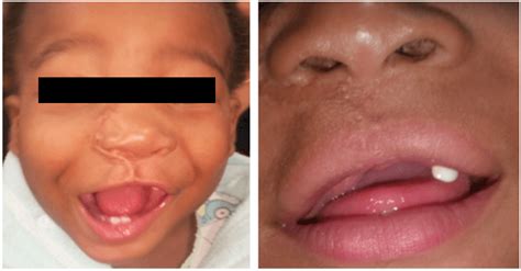 A Case Report On Melanotic Neuroectodermal Tumor Of Infancy And Review Of The Literature