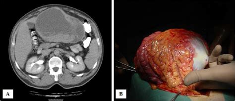 Gist Ct Scan Of A Large Dimension Gist Invading Adjacent Transverse Download Scientific