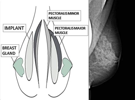 Localisation Of Breast Implants Left Submammary Implant Located In
