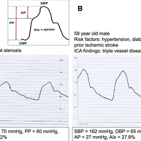 Invasively Measured Central Aortic Pressure Waveforms And Associated Download Scientific