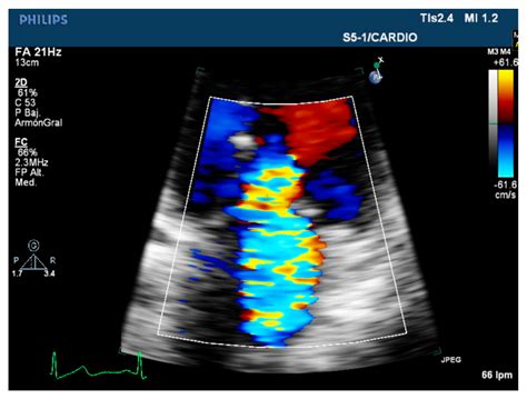 Practical Echocardiographic Approach Of Regurgitant Mitral Valve Assessment Encyclopedia Mdpi