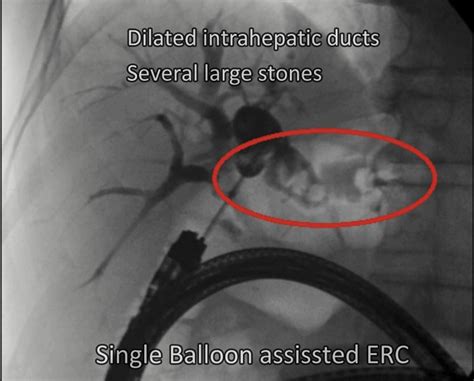 Eus Guided Hepaticogastrostomy To Facilitate Cholangioscopy And Electrohydraulic Lithotripsy Of