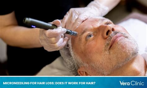 Microneedling For Hair Loss Does It Work For Hair
