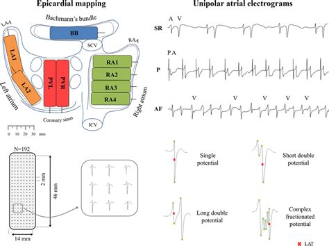 Epicardial Mapping To Retrieve Unipolar Atrial Electrograms With The Download Scientific