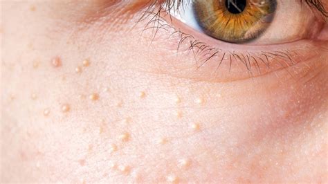 Как избавиться от жировиков 5 способов удалить жировик в домашних условиях Youtube