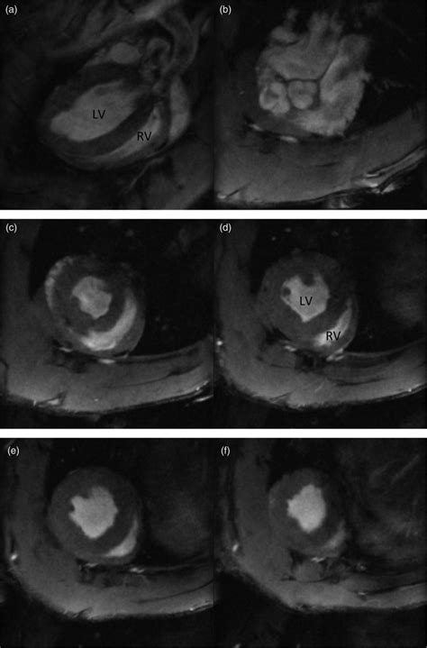 Cardiac Mri Short Axis Image Taken From A Long Axis A And A Short Download Scientific Diagram