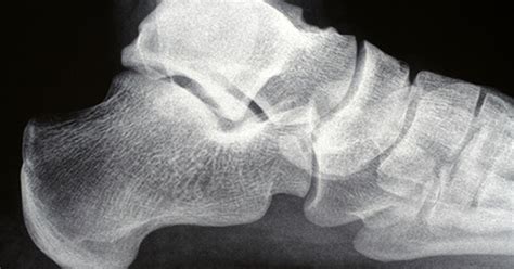 What Is Lucency On X Rays Ehow Uk