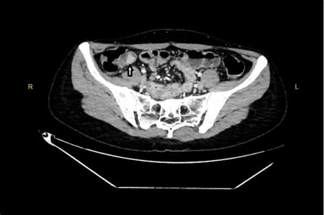 The Image Of The Appendix Section Arrow On The Abdominal And Download Scientific Diagram