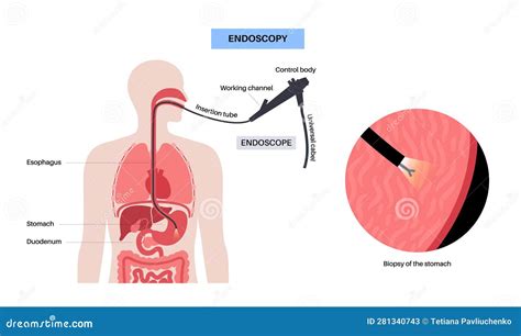 Gastroscopy Endoscopy Procedure Stock Vector Illustration Of Gastric