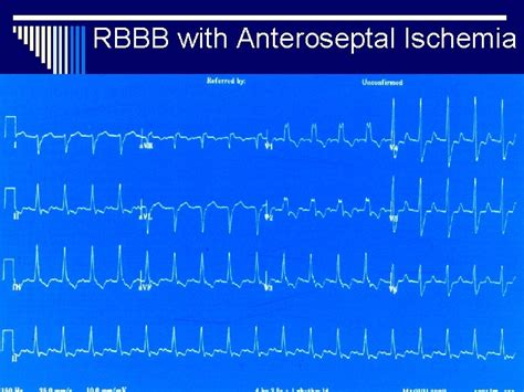Diagnosis Of Myocardial Infarctionischemia With Bundle Branch Blocks