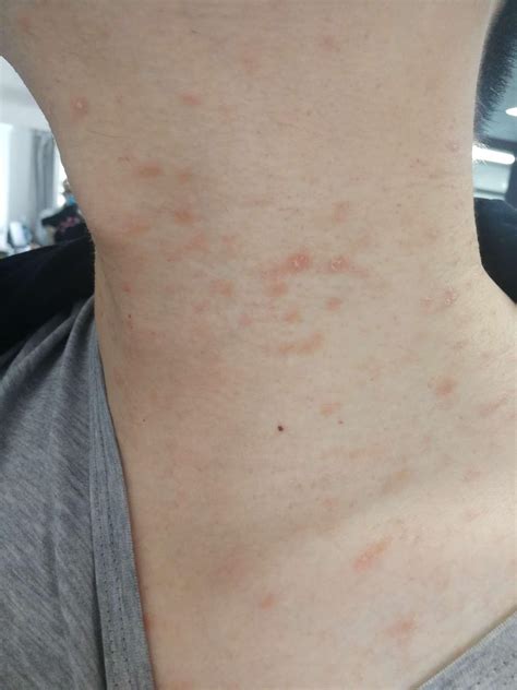 玫瑰疹图片和症状图片 红丘疹图片和症状图片 伤感说说吧
