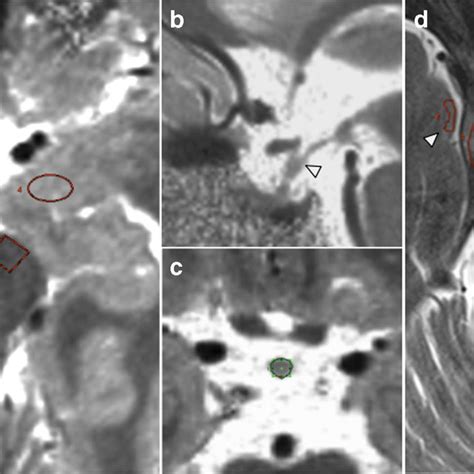 Example Of A Pituitary Adenoma With A Different Knosp Score At 3 T Download Scientific Diagram