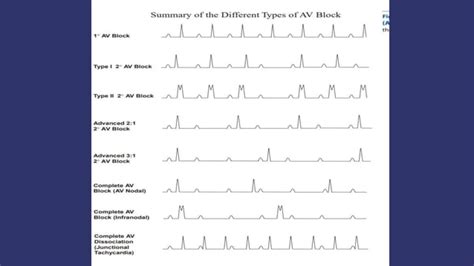 Atrioventricular Blocks Pptx