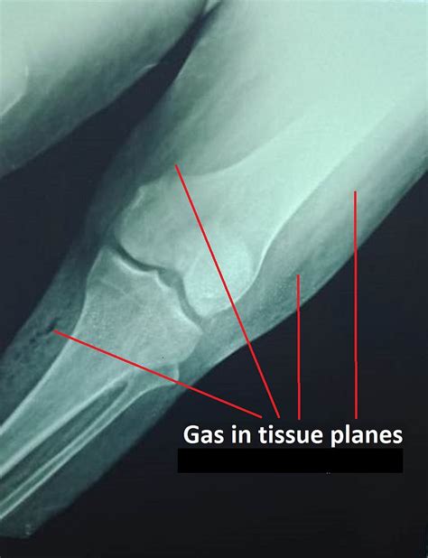 Gas Gangrene And Other Necrotising Infections