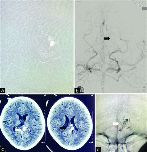 Endovascular Glue Embolization A Super Selective Digital Subtraction