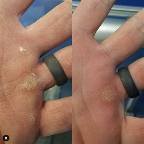 Callus Hand