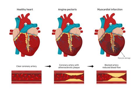 Angina Pectoris • Ursachen Und Symptome Tugy