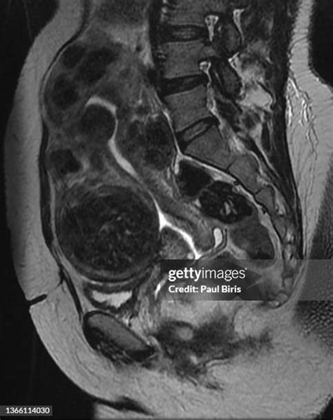 Sagital Mri Photos Et Images De Collection Getty Images