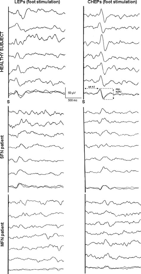Laser Evoked Potentials Semantic Scholar