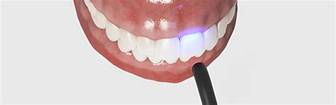 How To Choose The Right Shade Of Composite Dental Bonding