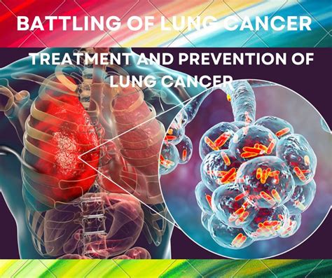 Treatment And Prevention Of Lung Cancer Healthy Life With Dr Shaista
