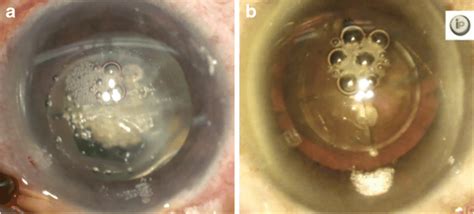 Lens Fragmentation Pattern In Femtosecond Laser Assisted Cataract Download Scientific Diagram