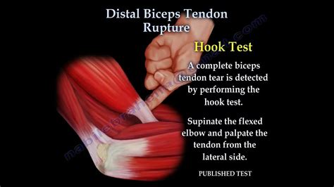 What Is Bicep Tendonitis