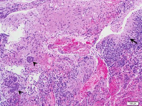 Histological Examination Showed An Infiltrating Neoplasm Composed Of