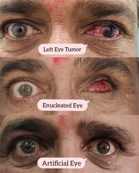 Eyecancer Eyetumor Enucleation Artificialeye Eyeprosthesis