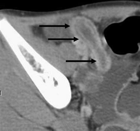 Ct Evaluation Of Appendicitis And Its Complications I