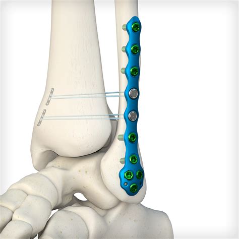 Lateral Flex Fibula Plates Unite Foot And Ankle