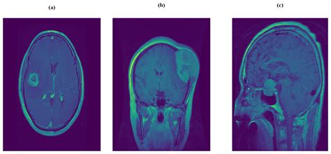 Enhancing Brain Tumor Mri Classification With An Ensemble Of Deep Learning Models And