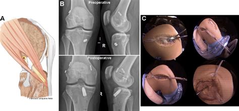 A Illustration Of Lateral Extra Articular Tenodesis Using The