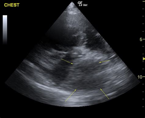 15 00220 Thunder G Heartbase Mass With Caval Obstruction Mi Ti