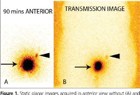 Figure 1 From Utility Of Spectct In Sentinel Lymph Node Detection In A