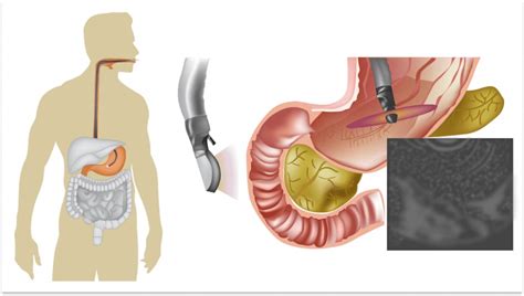 Endoscopic Ultrasound Acorn Gastroenterology