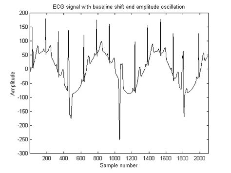 Qrs Detection Ecg With Baseline Shift And Amplitude Oscillation Figure Download Scientific