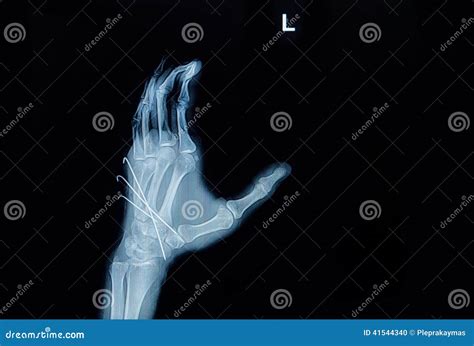手破裂影片x 射线：显示破裂掌骨inse 库存照片 图片 包括有 破裂 矫形 腕骨 光芒 痛苦 41544340