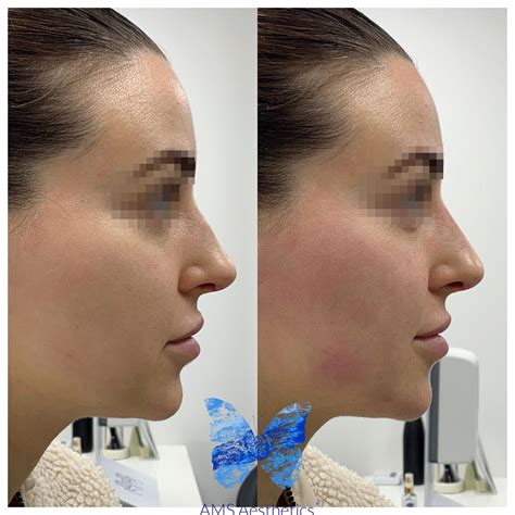Non Surgical Rhinoplasty Nose Job London Nose Filler