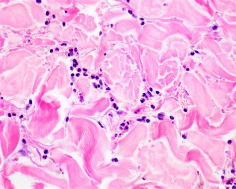 Pathology Outlines Urticaria Hives
