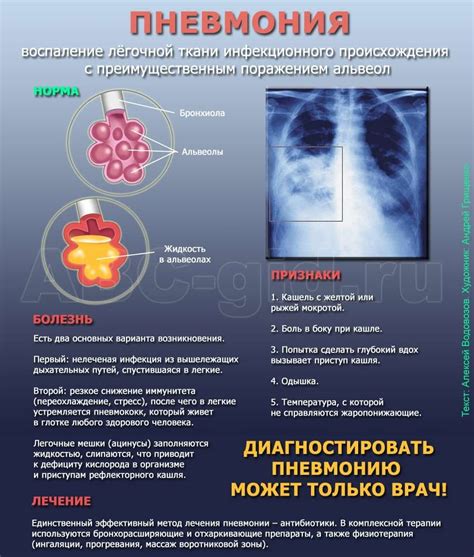 Пневмония на рентгене как выглядит воспаление легких на рентгеновском