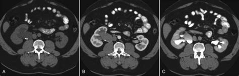 Management Of Upper Urinary Tract Obstruction Abdominal Key