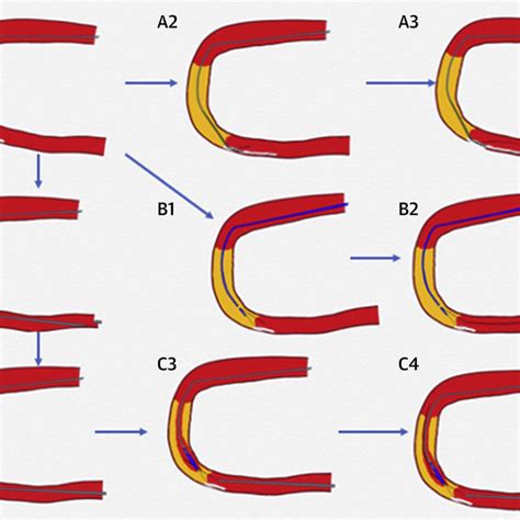 Approaches To Subintimal Guidewire Entry Download Scientific Diagram