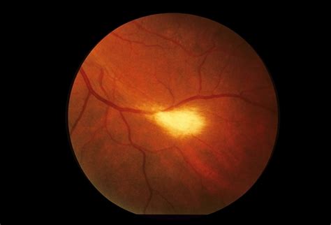 Armd Rpe Defect Myelinated Nfl Retina Image Bank