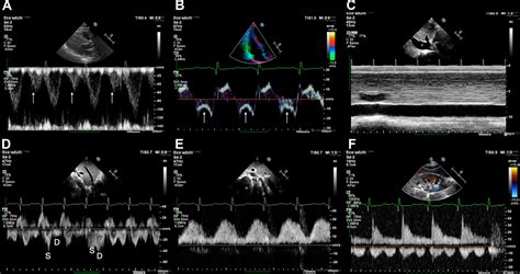 Right Ventricular Diastolic Dysfunction And Venous Pulsatile Pattern Chest