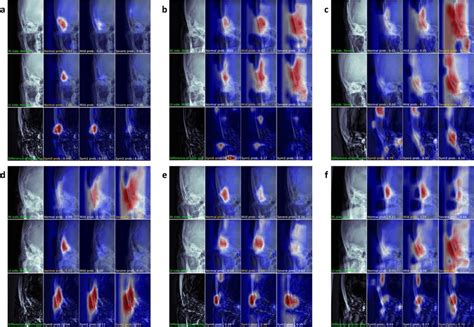 Class Activation Mappings From Deep Learning Algorithm Using Both Sides